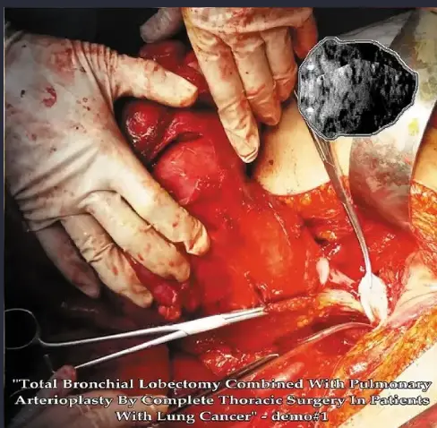 Bronchiectasis Total Bronchial Lobectomy Combined With Pulmonary ...